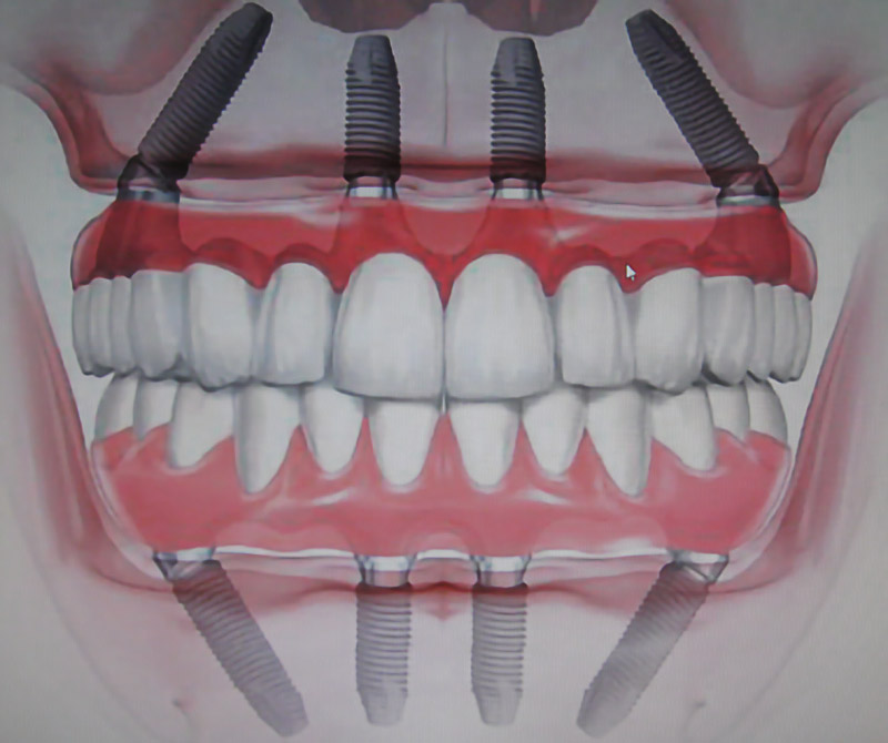Cena zubnih implanta || Dental implant expert -Implanti