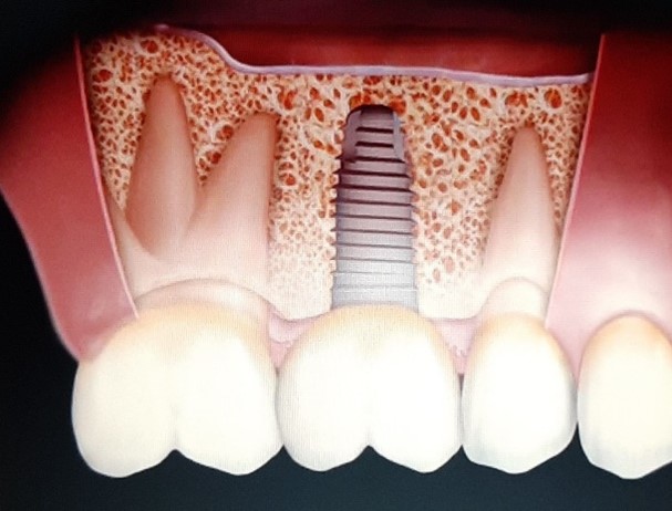Sinus Lift - Dental implant expert Beograd